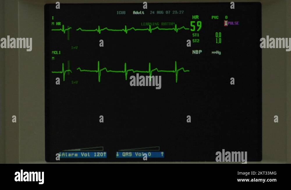 Normal ekg Stock Videos & Footage - HD and 4K Video Clips - Alamy