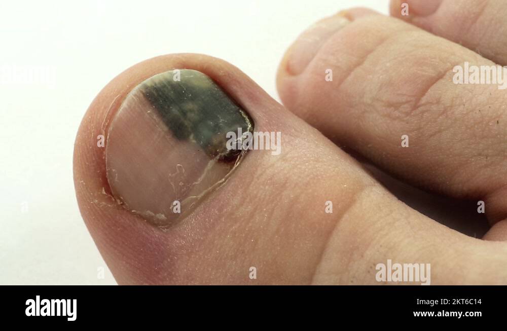 Subungual hematoma. Bruise under the nail of big toe Stock Video ...