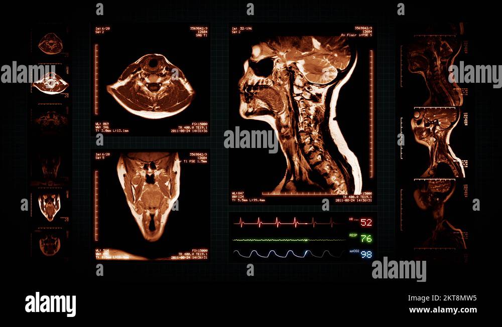 Neck MRI Scan. Amber. 3 in 1. Top, front, lateral view and ECG display ...