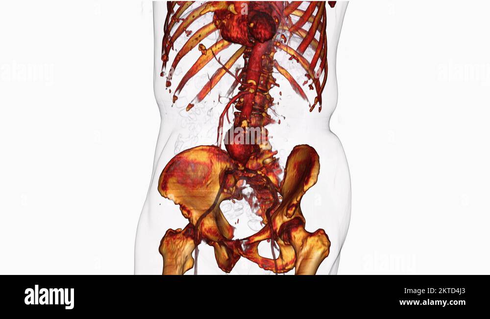 Aortic Atherosclerosis Stock Videos And Footage Hd And 4k Video Clips Alamy
