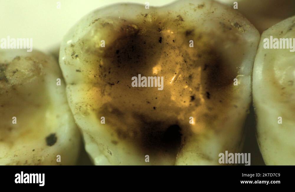 Decaying teeth Stock Videos & Footage - HD and 4K Video Clips - Alamy