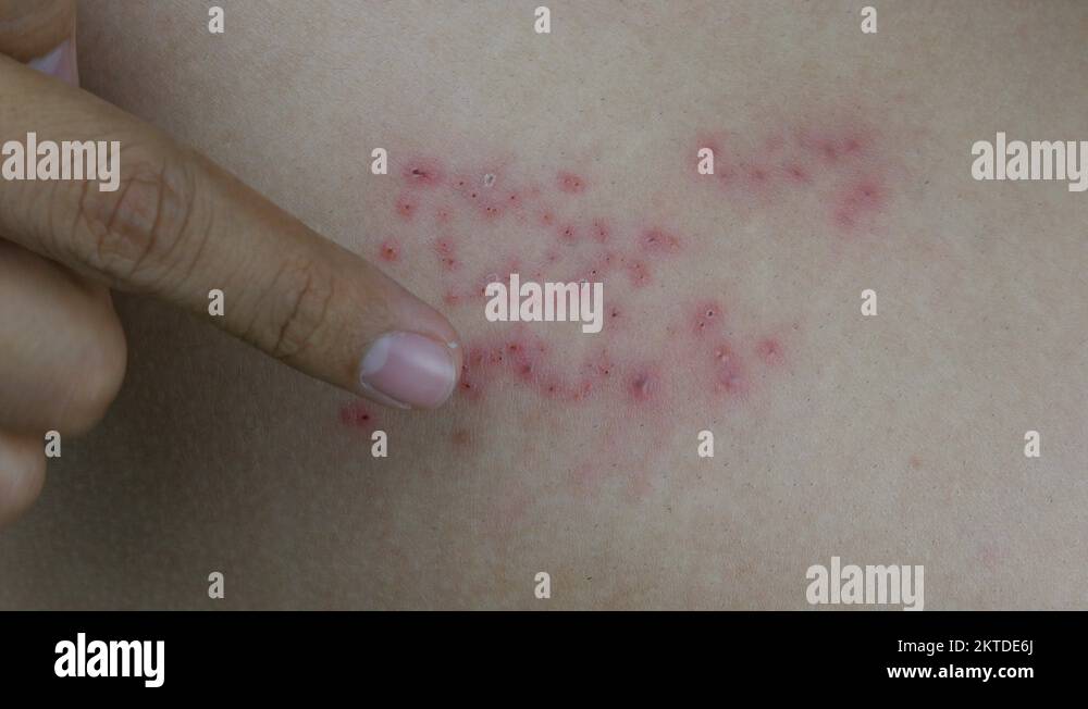 Raised bumps on back Stock Videos & Footage - HD and 4K Video Clips - Alamy