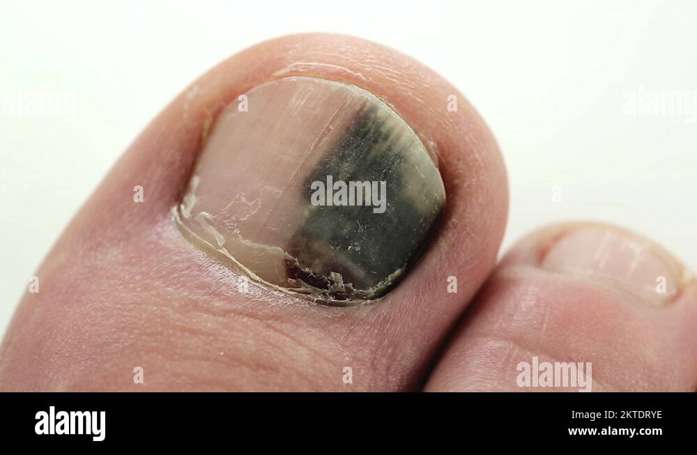 Trauma of toenail. Subungual hematoma Stock Video Footage - Alamy