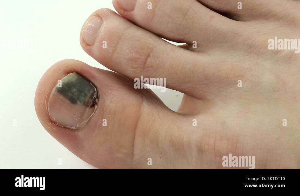 Subungual hematoma. Bruise under the nail of big toe Stock Video ...
