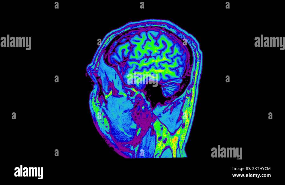 Brain Mri Sagittal View Stock Video Footage Alamy