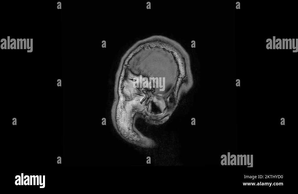 Mri brain scan sagittal view Stock Videos & Footage - HD and 4K Video ...