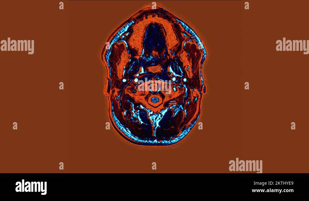 Axial mri healthy brain Stock Videos & Footage - HD and 4K Video Clips ...