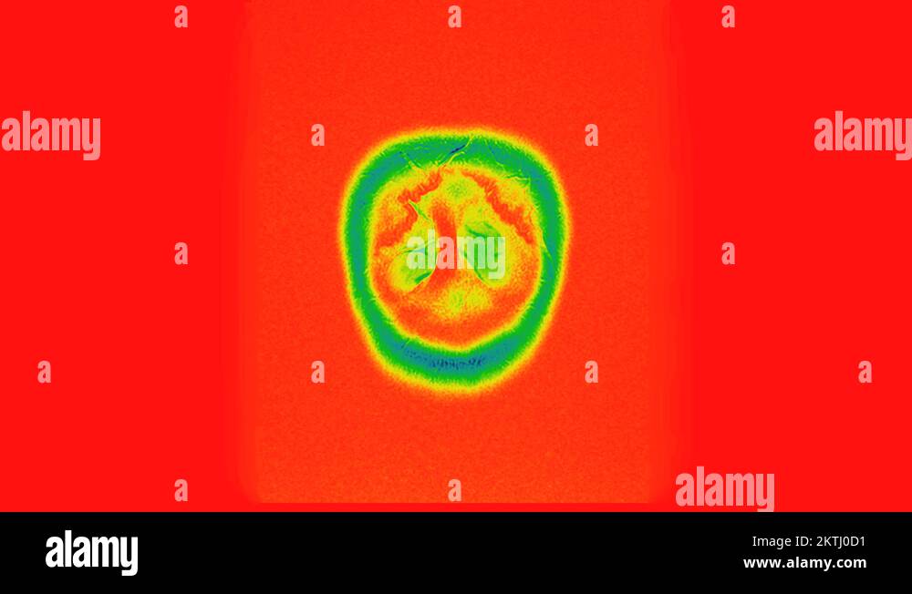 Ct Scan Brain Normal Stock Videos And Footage Hd And 4k Video Clips Alamy