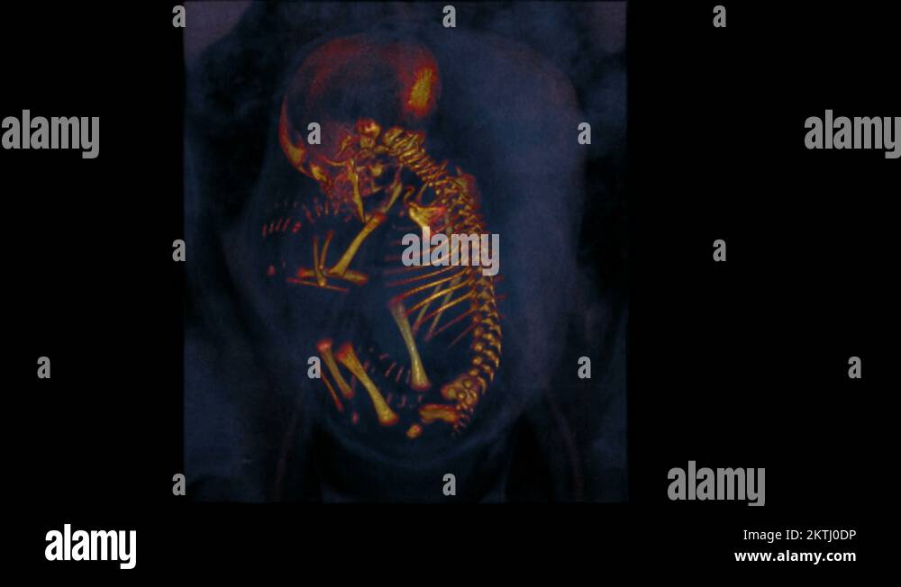 CT scan showing a full term human fetus Stock Video Footage - Alamy
