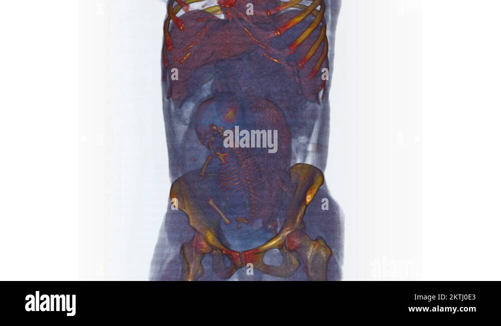 CT scan showing a full term human fetus Stock Video Footage - Alamy