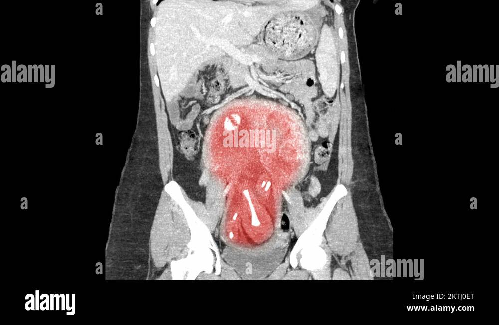 CT scan showing a full term human fetus Stock Video Footage - Alamy