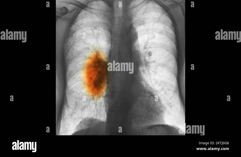 Chest x-ray showing lung cancer in an elderly man Stock Video Footage ... Chest x-ray showing lung cancer in an elderly man Stock Video Footage ...