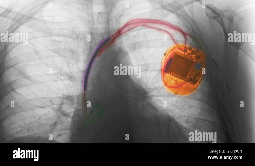 Chest x ray pacemaker Stock Videos & Footage - HD and 4K Video Clips ...