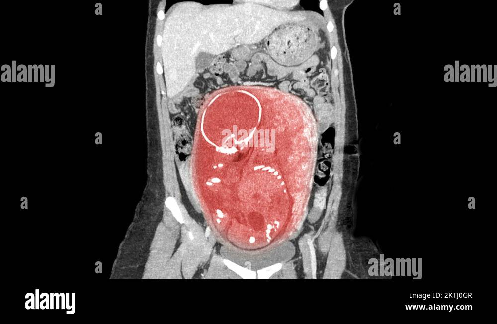 CT scan showing a full term human fetus Stock Video Footage - Alamy