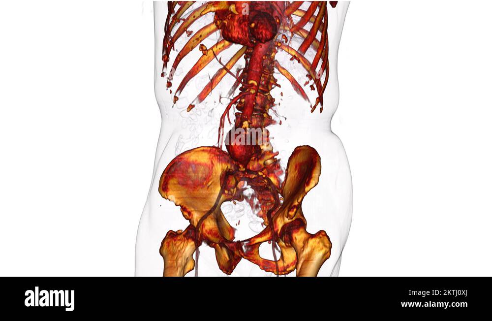 Abdominal aorta 3d ct scan Stock Videos & Footage - HD and 4K Video ...