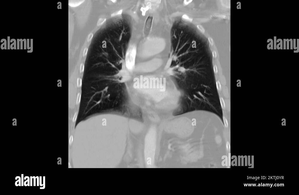 CT scan animation showing a large lung cancer in the right upper lobe ...
