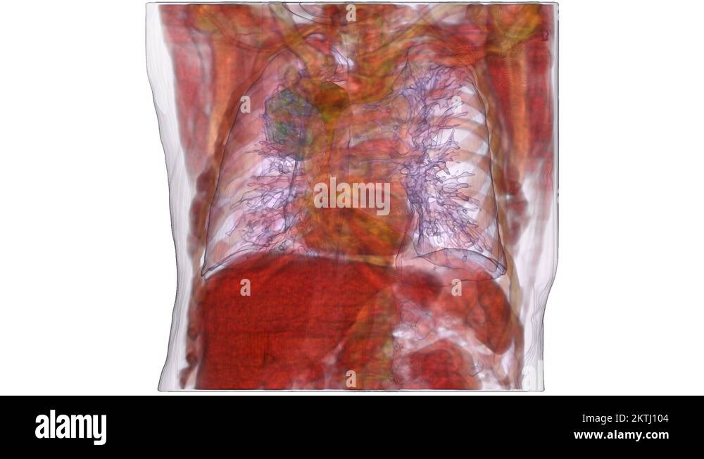 Ct Scan Animation Showing A Large Lung Cancer In The Right Upper Lobe Stock Video Footage Alamy