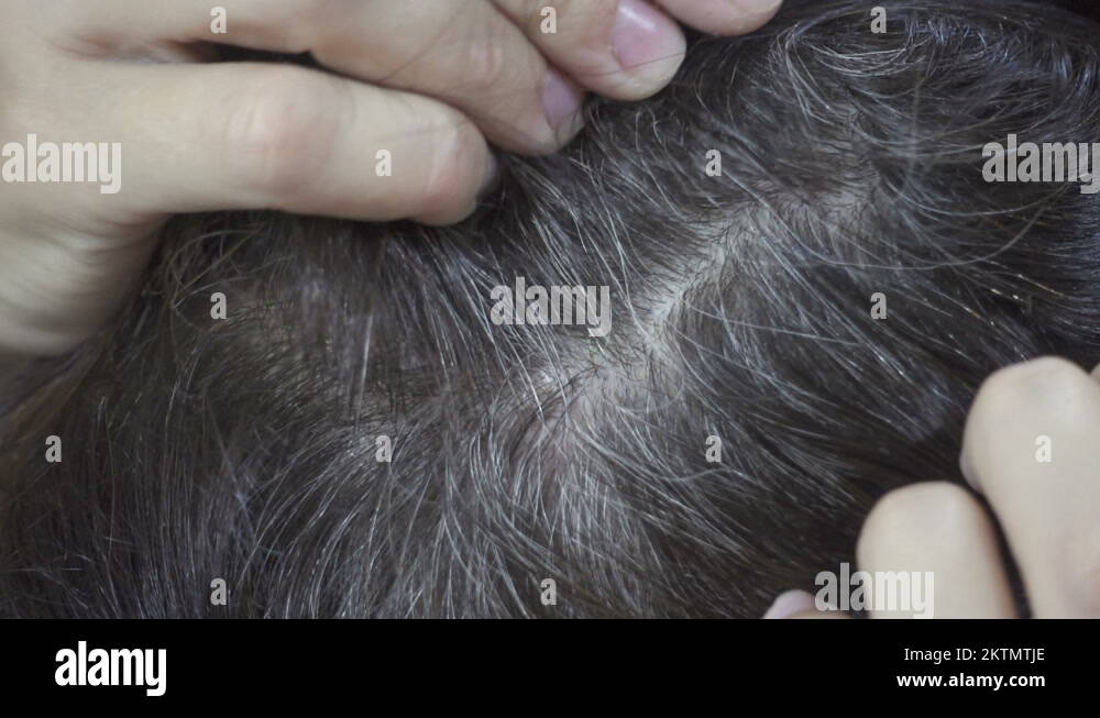 Female head with grey hair close up. Woman showing dandruff and gray ...