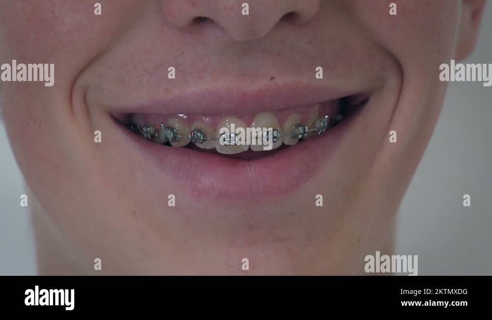 Boy with braces Stock Videos & Footage - HD and 4K Video Clips - Alamy