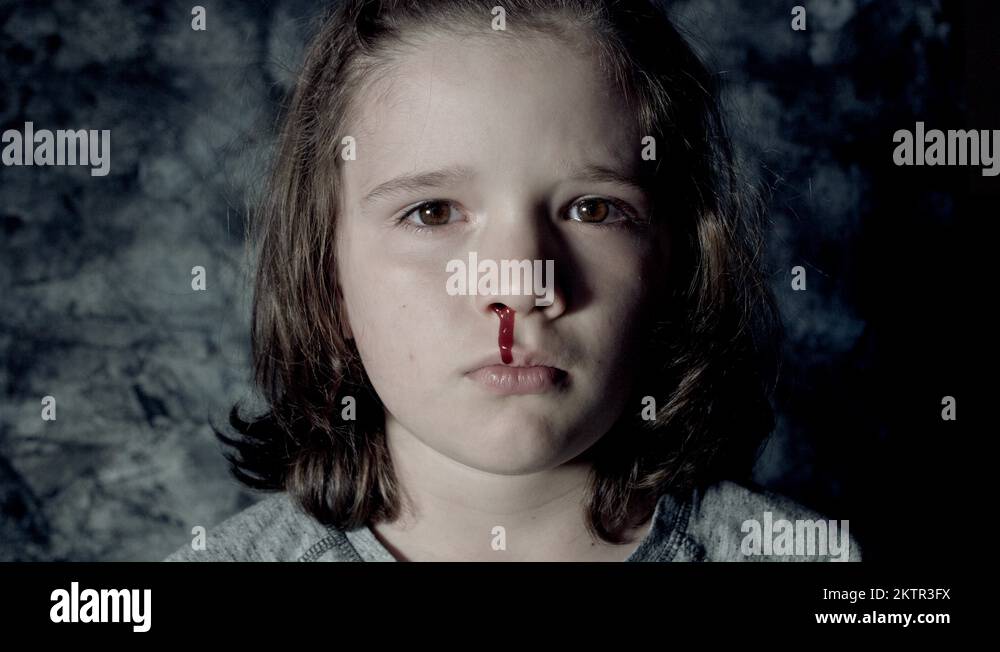Nose bleeding child Stock Videos & Footage - HD and 4K Video Clips - Alamy