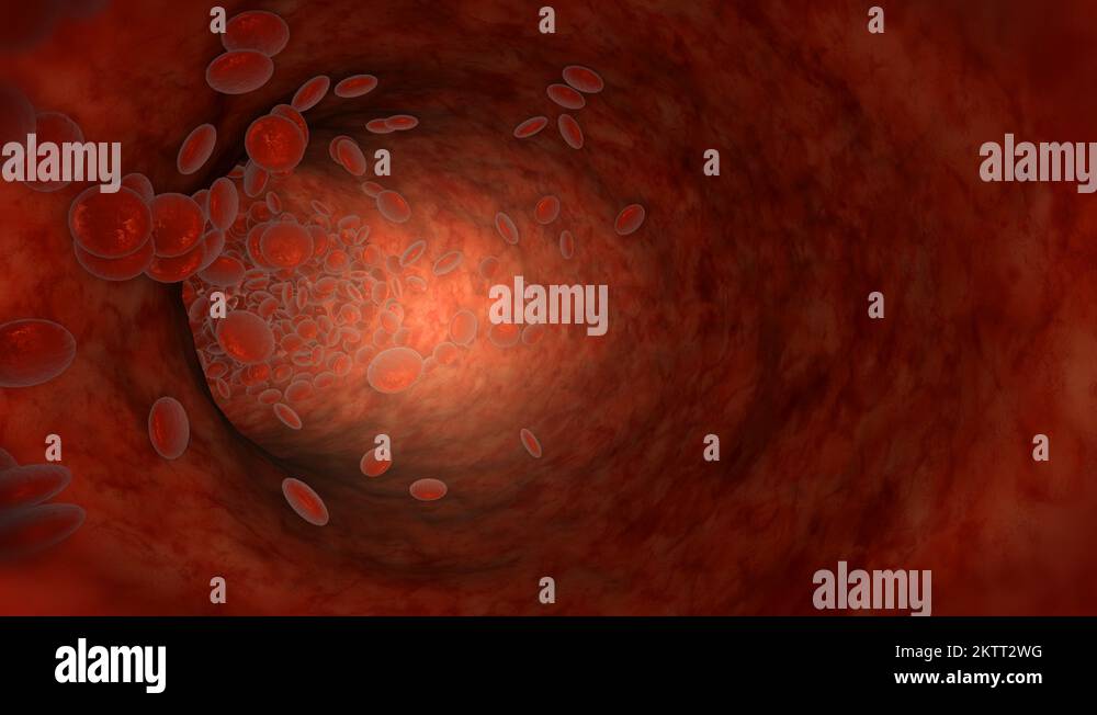 Blood flow obstruction Stock Videos & Footage - HD and 4K Video Clips ...