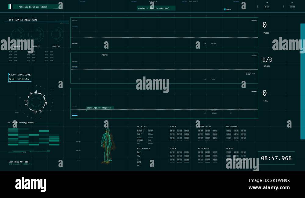 Patient's revival, ICU monitor with vital signs rising after cardiac ...