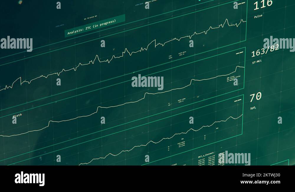 Patient dying, futuristic ICU monitor with dropping vital signs ...