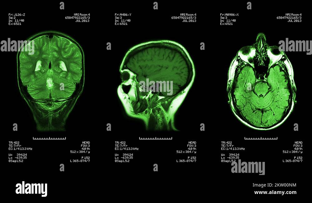 Head cancer scan Stock Videos & Footage - HD and 4K Video Clips - Alamy