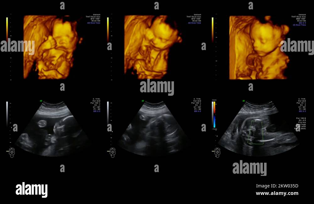 Ultrasonography of Fetus Stock Video Footage - Alamy