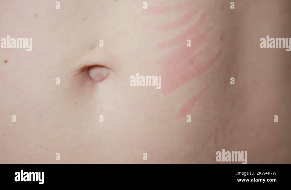 hyperemia. an allergic reaction to the body. hives. red spots on the ...