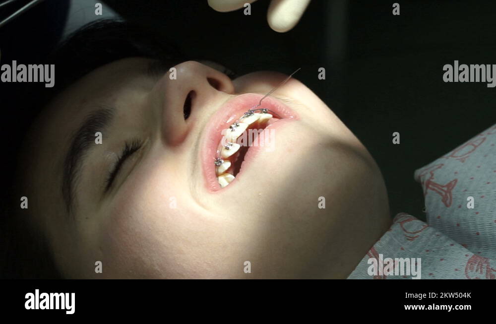 Orthodontic treatment. The boy is in his teens visiting the ...