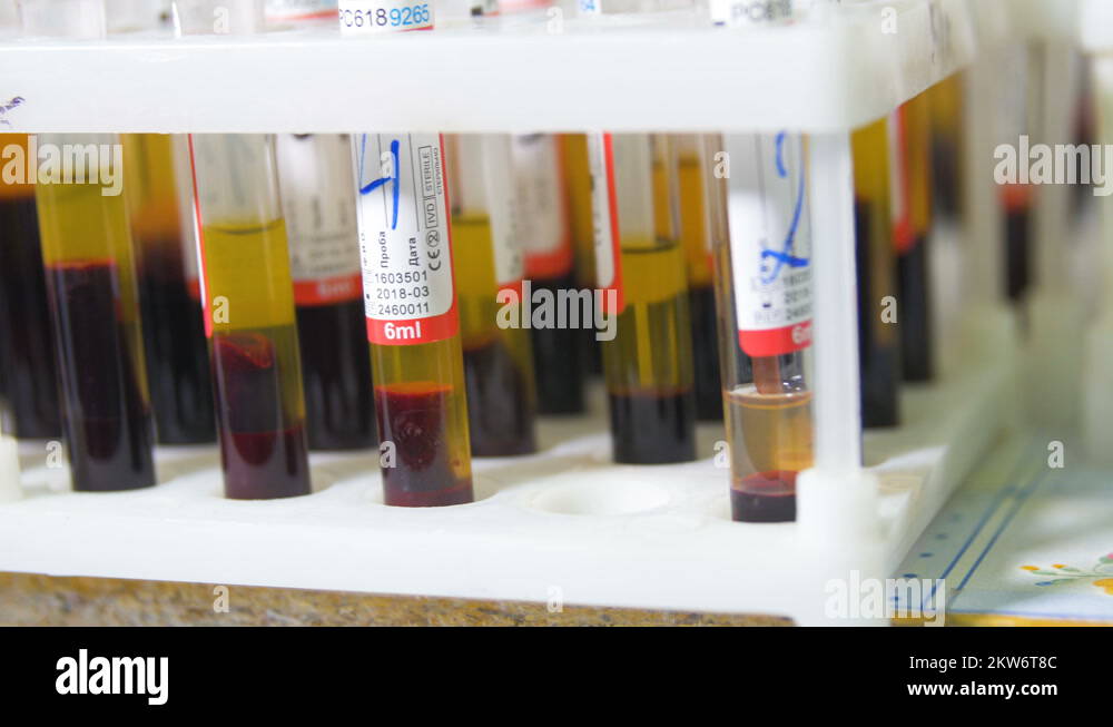 Blood samples vials Stock Videos & Footage - HD and 4K Video Clips - Alamy