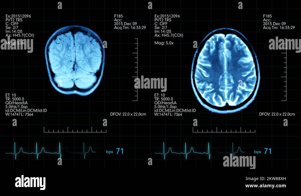 Two top view mri brain scan pictures animated on medical display with ...
