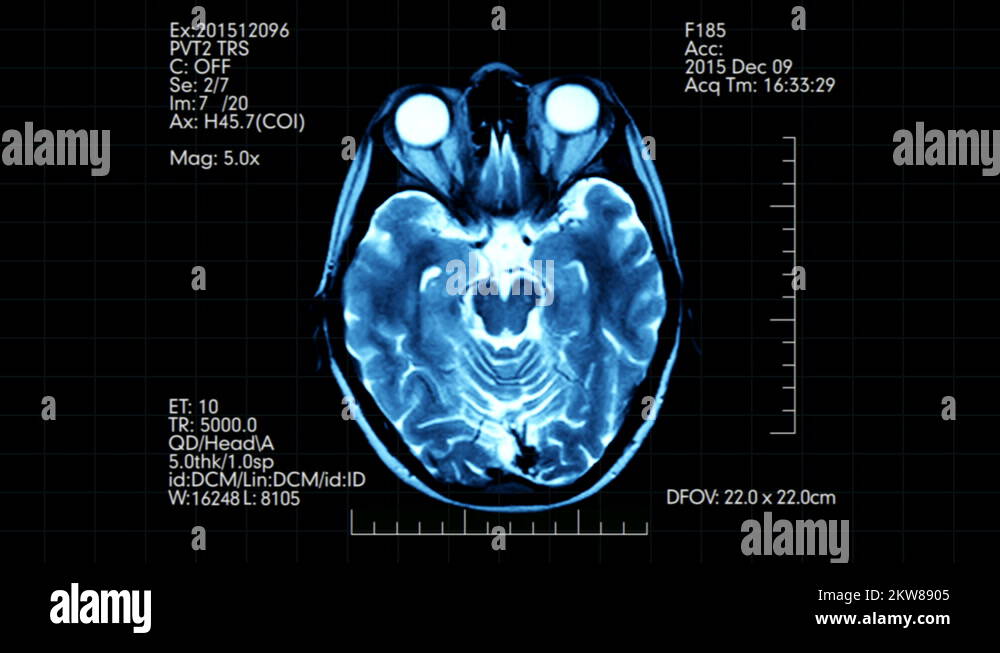 Top view teal color MRI brain scan display animation Stock Video ...