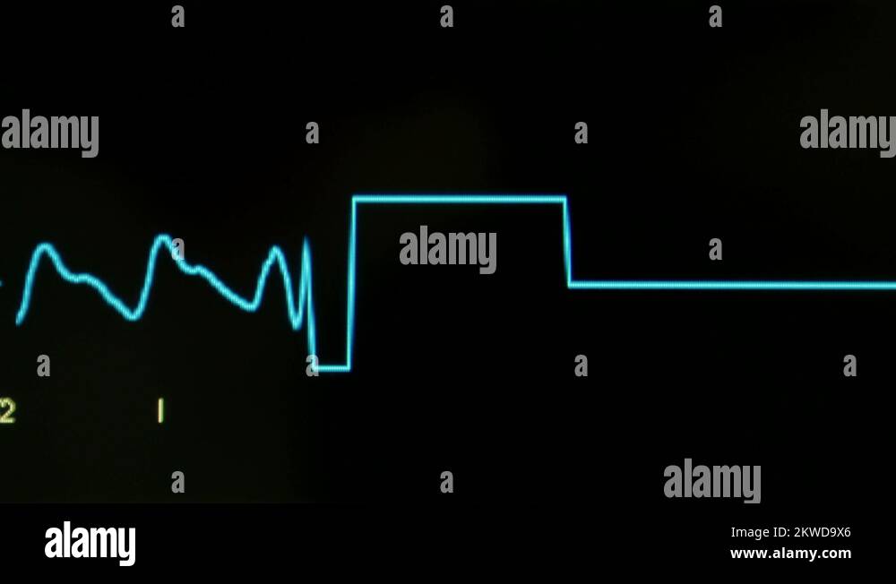 Flatline monitor Stock Videos & Footage - HD and 4K Video Clips - Alamy