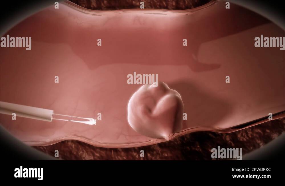 Polyp removal Stock Videos & Footage - HD and 4K Video Clips - Alamy