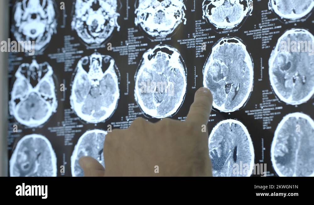 X-ray images of the brain in the operating room Stock Video Footage - Alamy