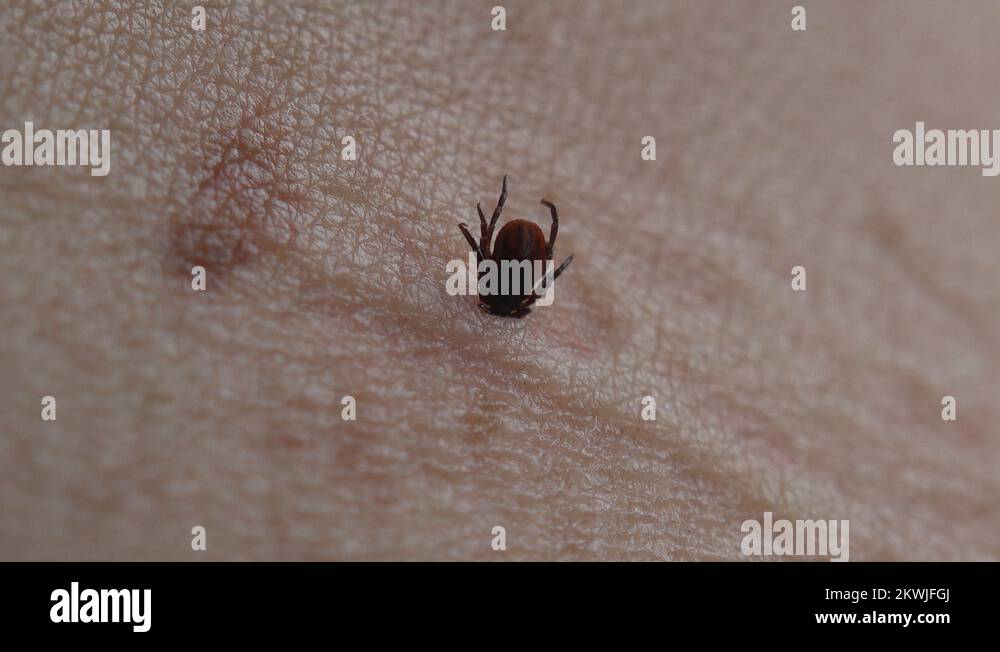 Insect 4k: Dermacentor as American Levi tick is Ixodidae drinks human ...