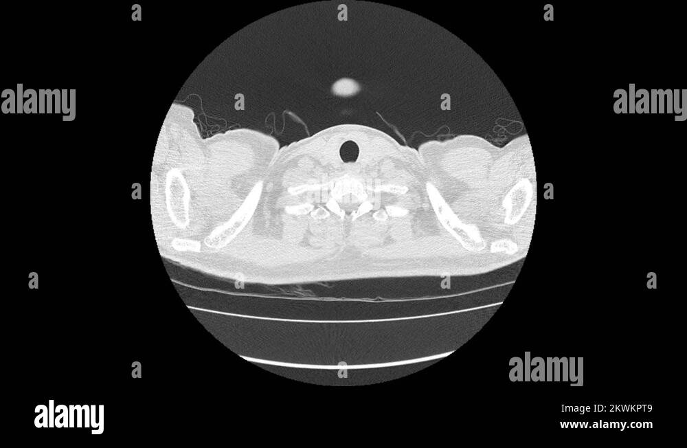 ct scan of upper abdomen top view smooth motion Stock Video Footage - Alamy