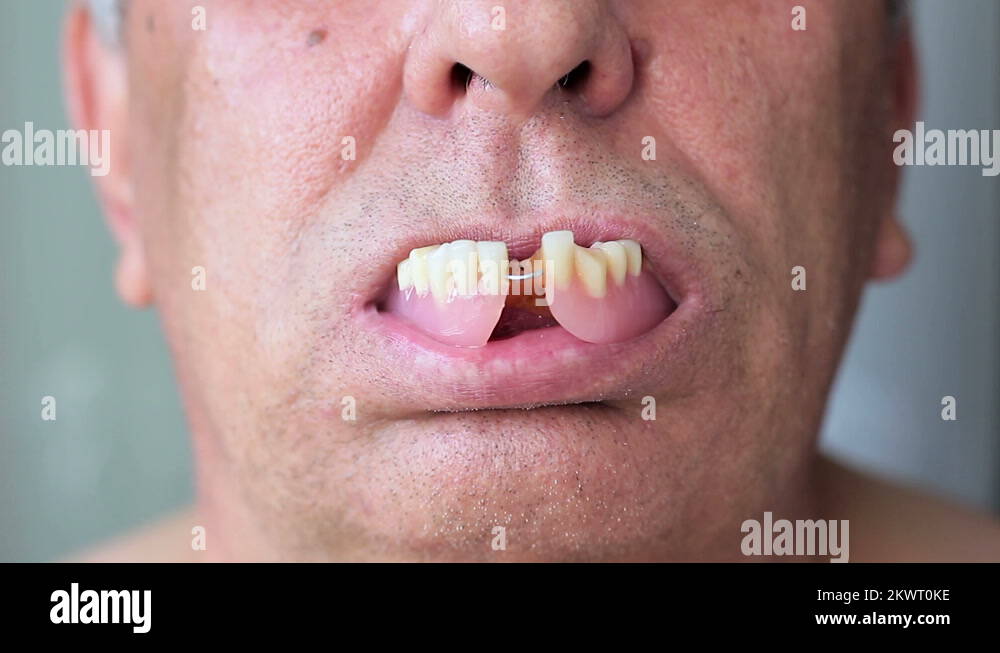 Denture mouth Stock Videos & Footage - HD and 4K Video Clips - Alamy