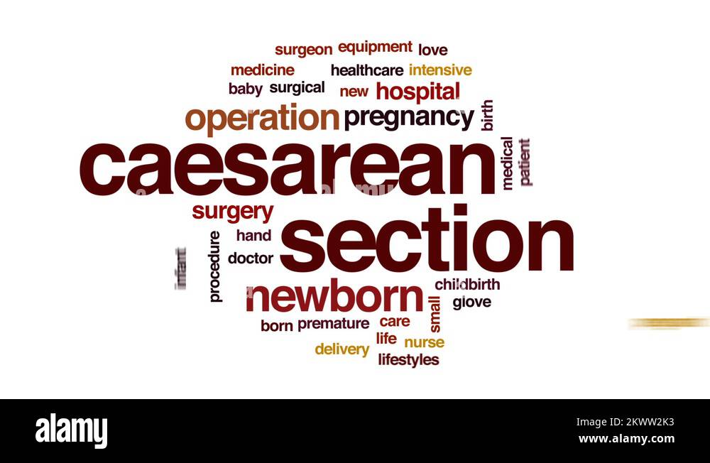 Caesarean section animated word cloud, text design animation Stock ...