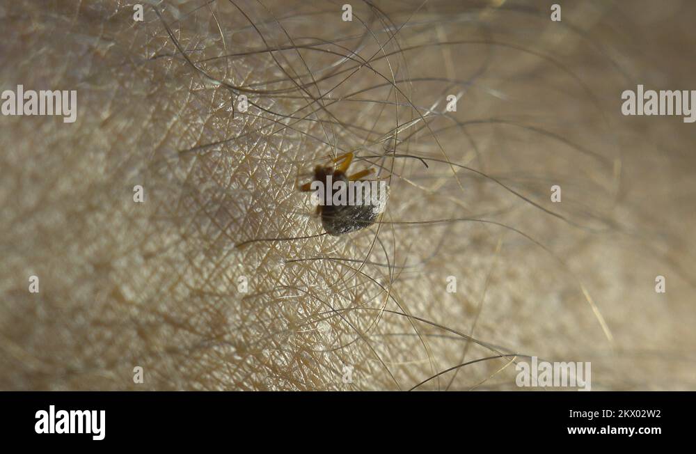 Insect macro 4k: Common bedbug parasite on human skin in bed at night ...