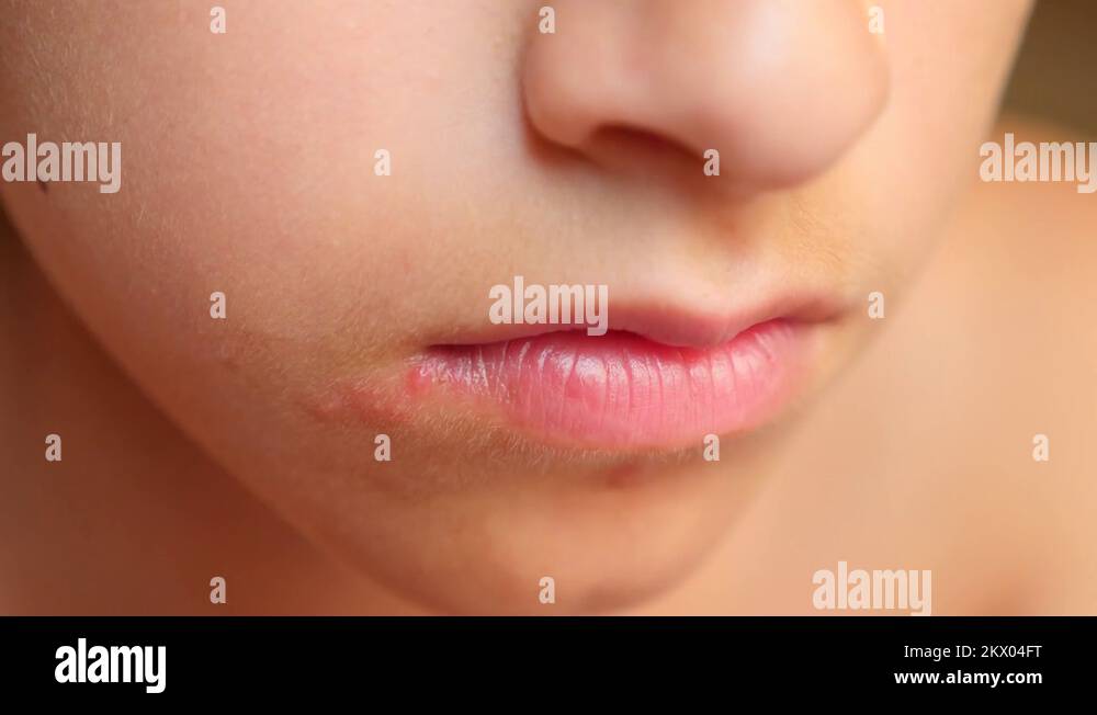 boy touching sores on the lips. herpes. lip treatment. 4k, slow-motion ...