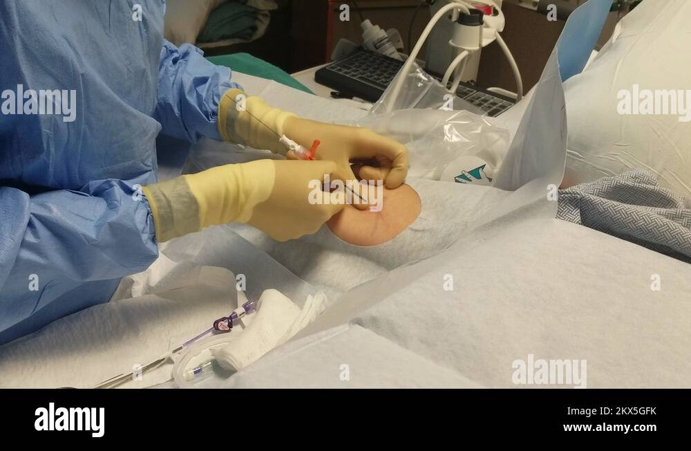 Surgery hospital cancer infusion insert procedure 4K Stock Video ...