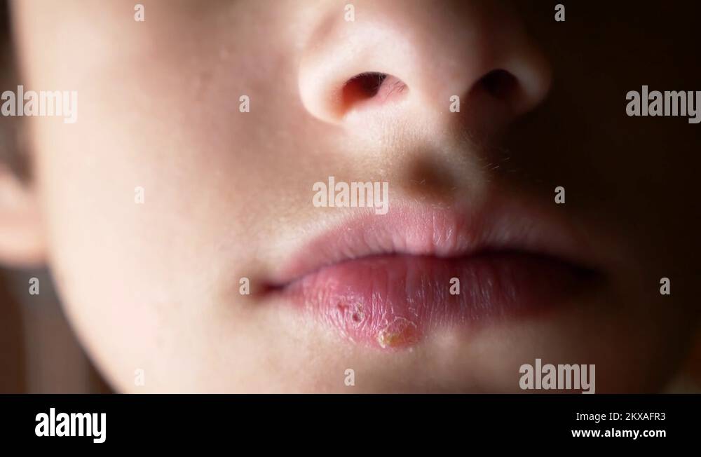 herpes on the lips of a boy. herpes. lip treatment. 4k, slow-motion ...