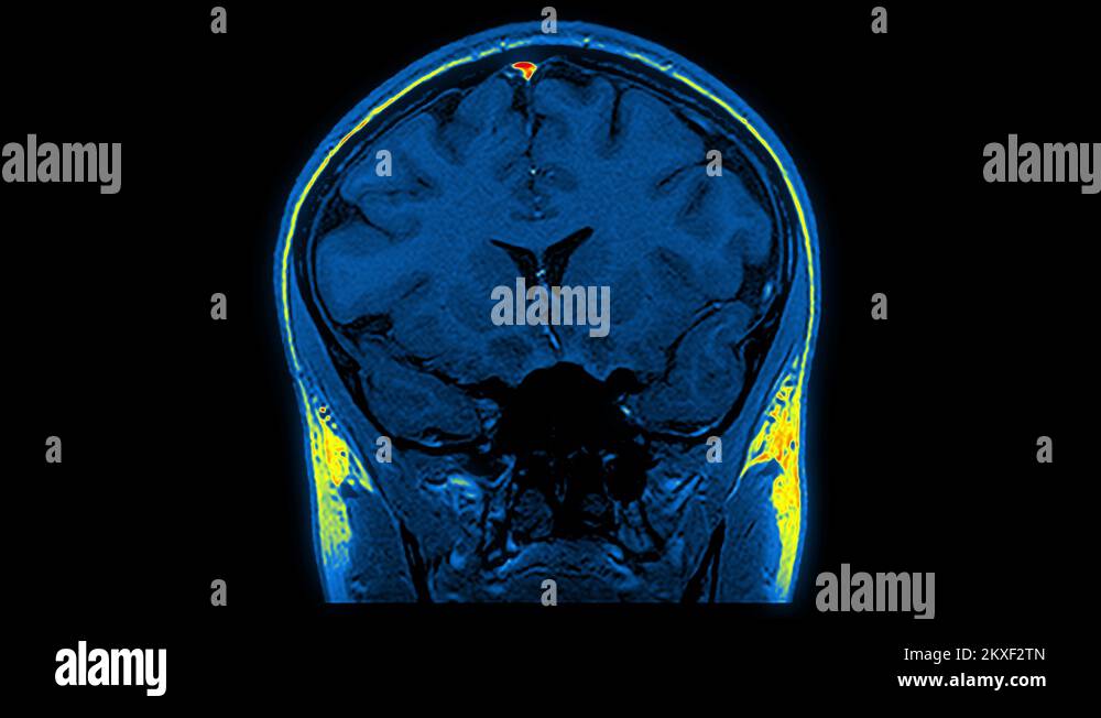 Computed Medical Tomography MRI Upscaled Scan of Healthy Young Female ...