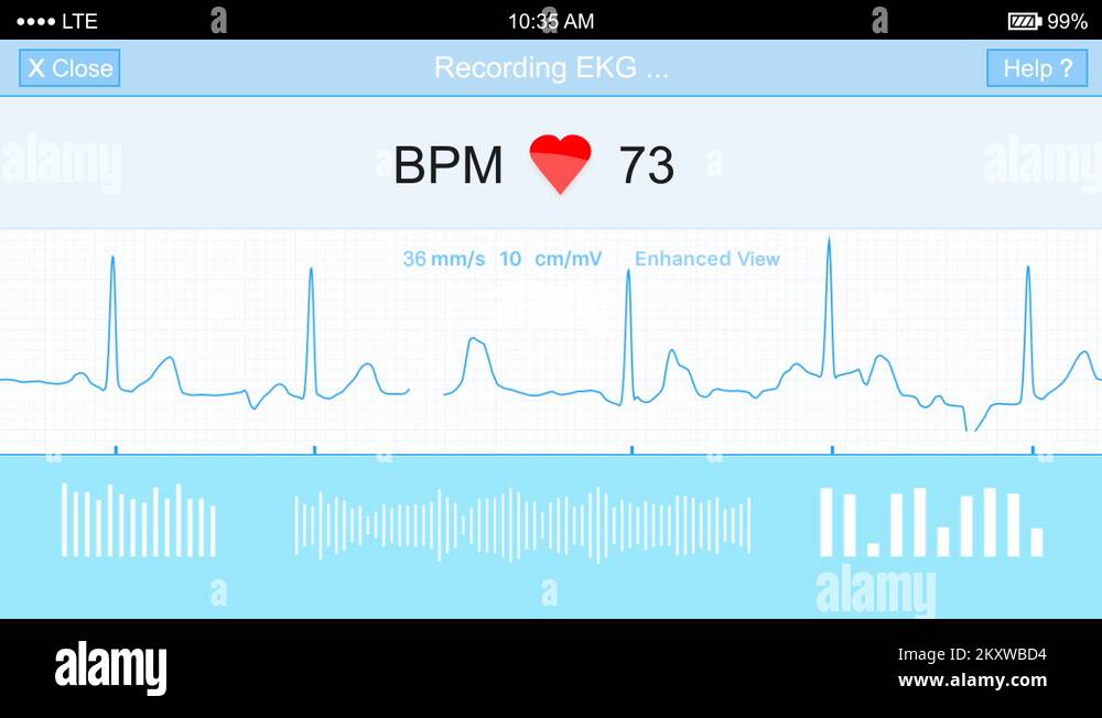 Ecg recording screen Stock Videos & Footage - HD and 4K Video Clips - Alamy