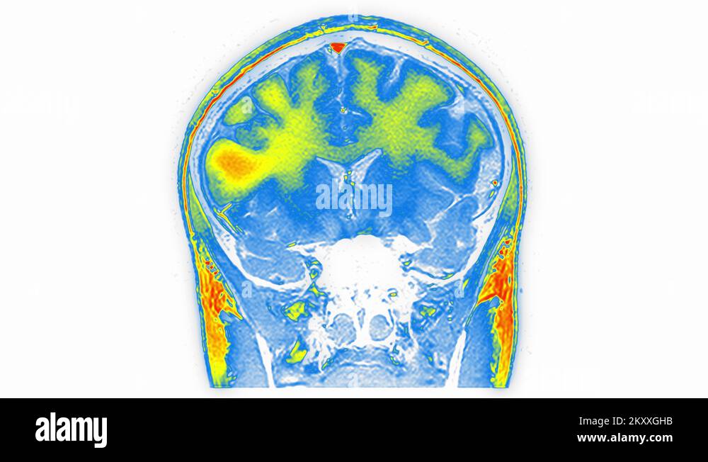 Computed Medical Tomography MRI Upscaled Scan of Healthy Young Female ...