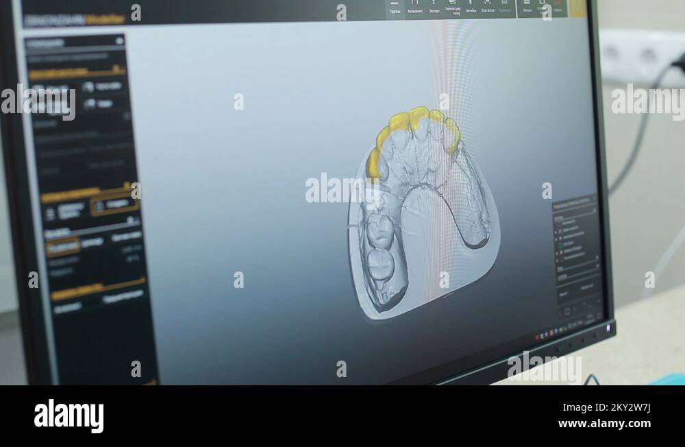 Creation on the computer model of the future prosthesis of teeth Stock ...