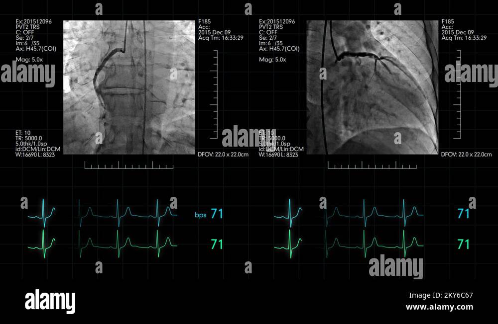 Cardiovascular monitoring Stock Videos & Footage - HD and 4K Video ...